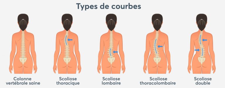 La scoliose - Osteo-Var